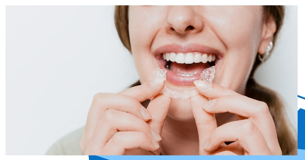 Starting With Invisalign | White House Dental Maple Ridge